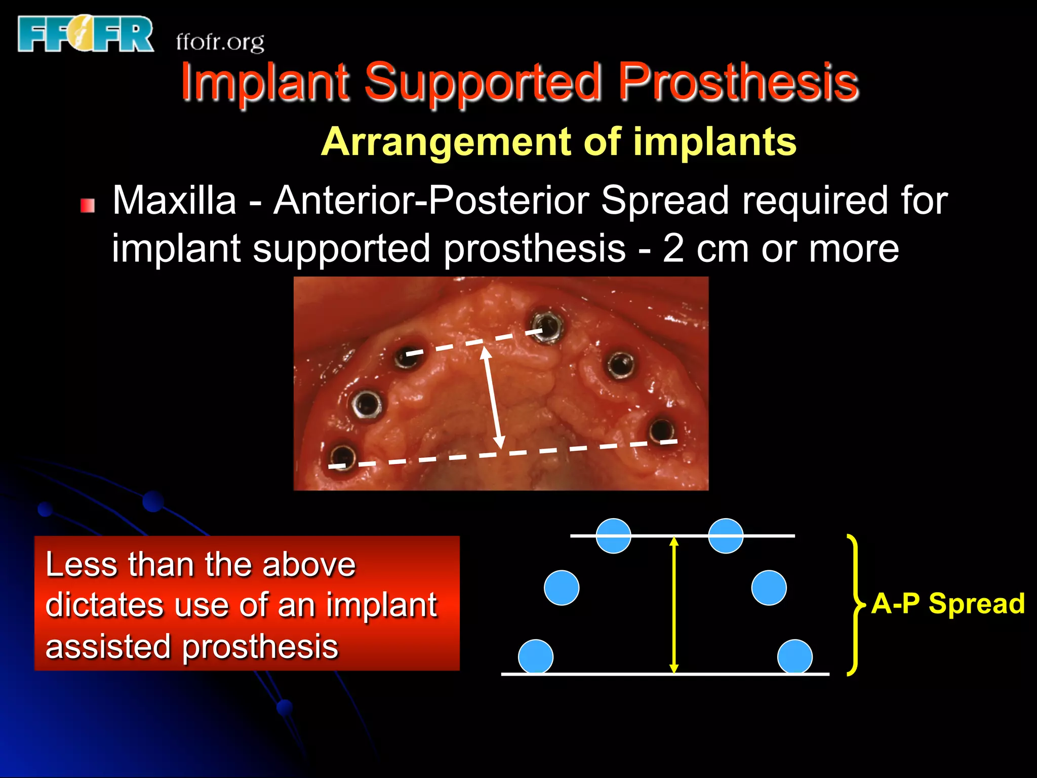 Edentulous Maxilla - Overlay Dentures | PDF
