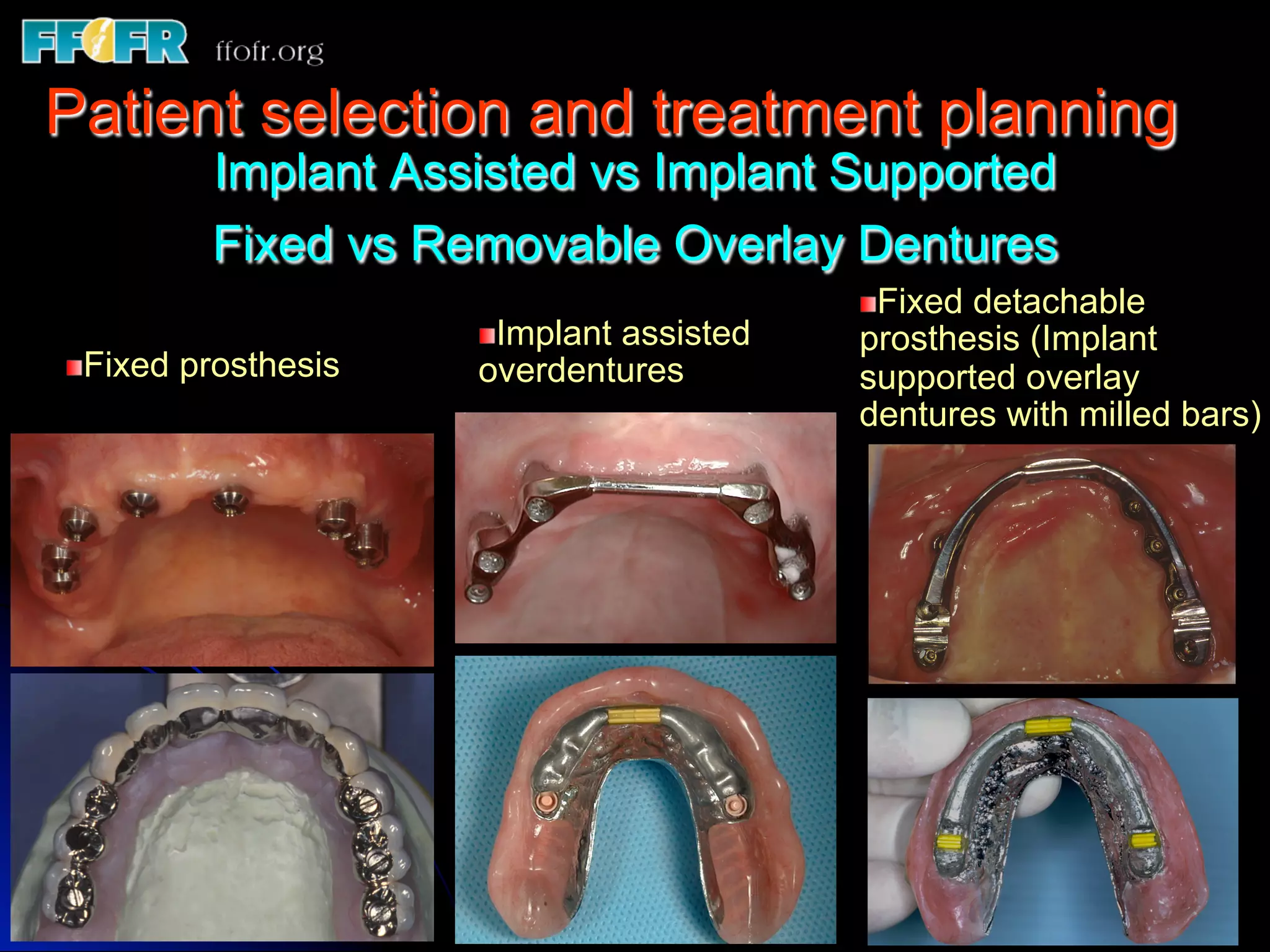 Edentulous Maxilla - Overlay Dentures | PDF