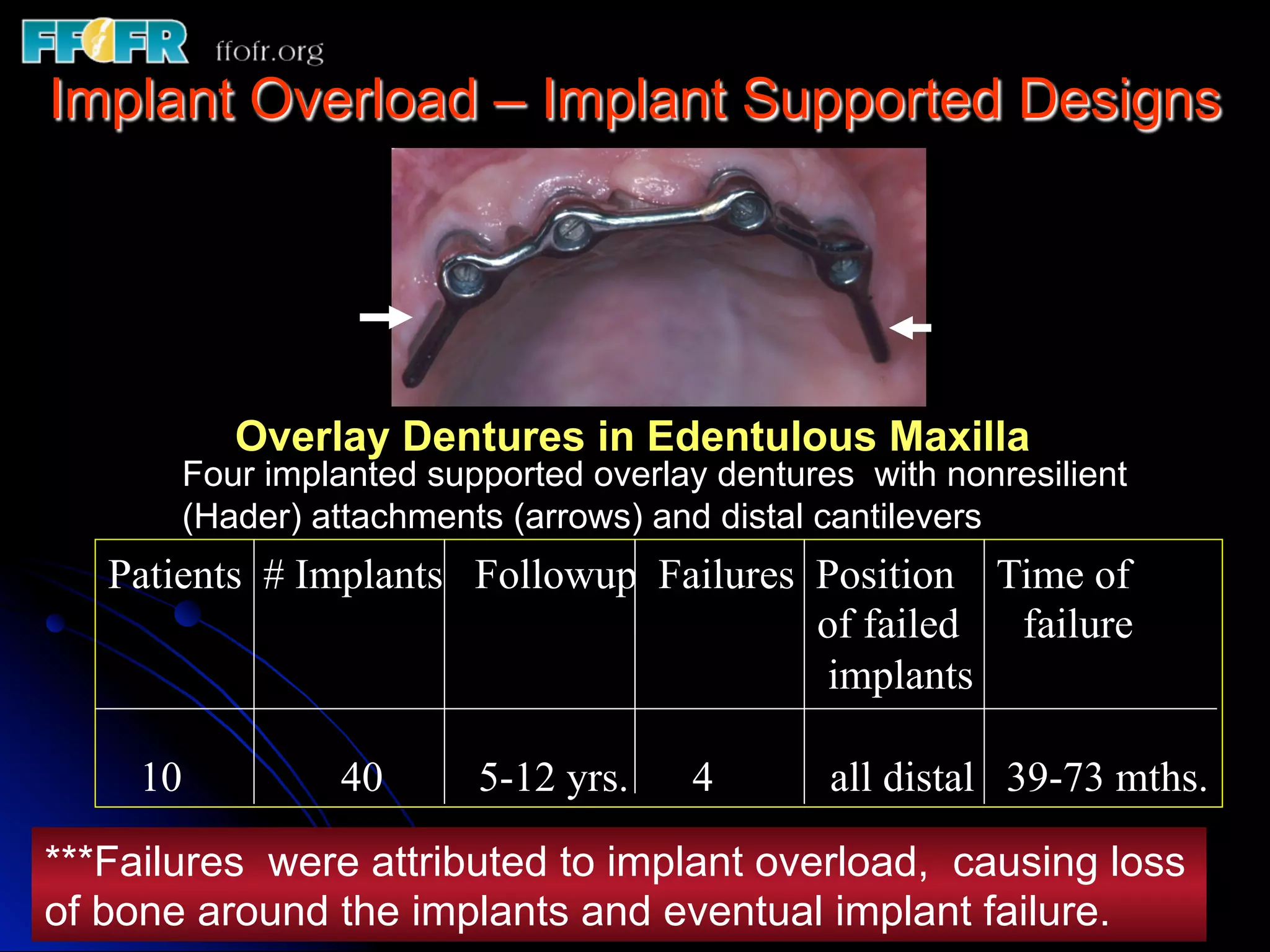 Edentulous Maxilla - Overlay Dentures | PDF