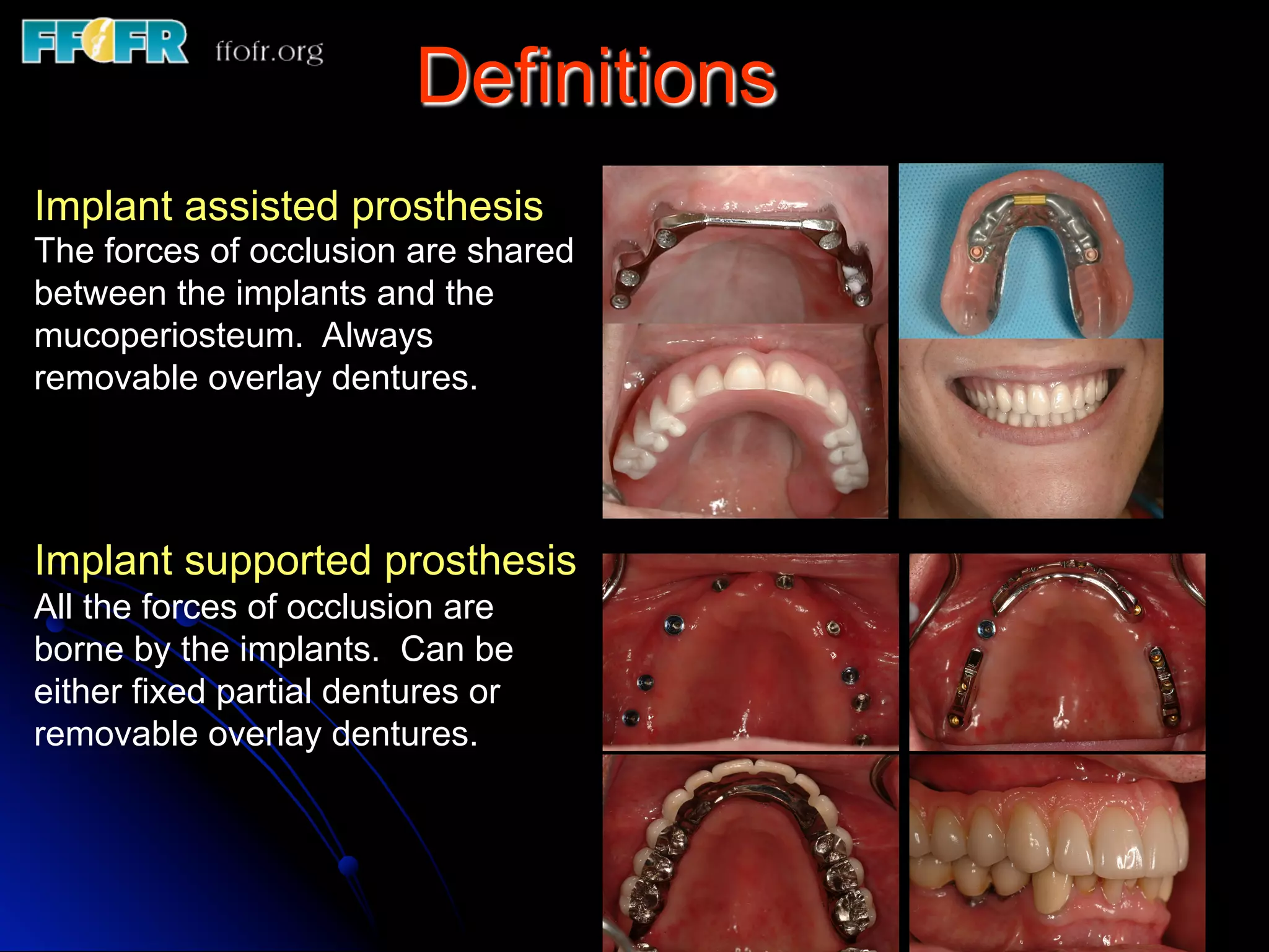 Edentulous Maxilla - Overlay Dentures | PDF