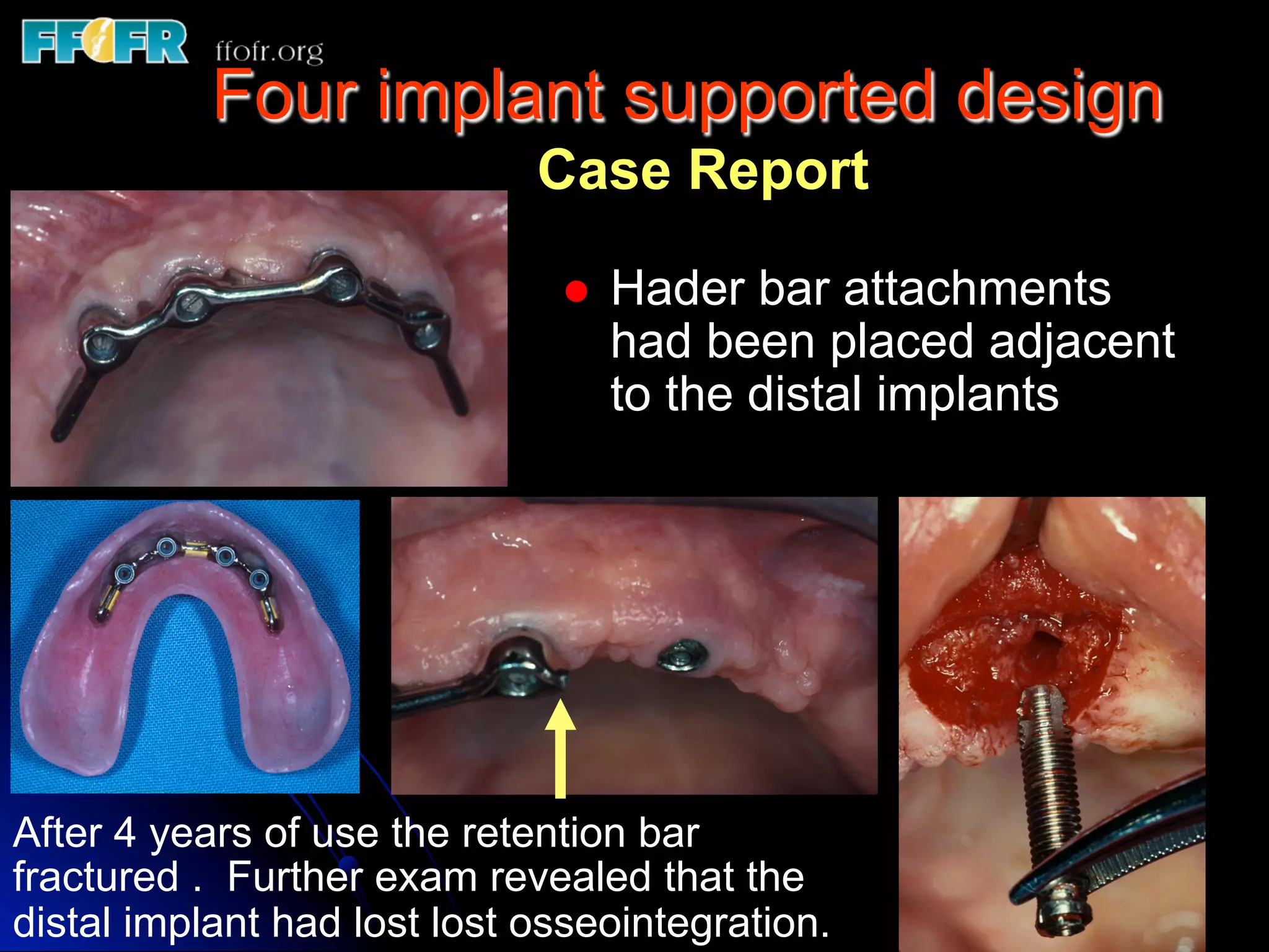 Edentulous Maxilla - Overlay Dentures | PDF