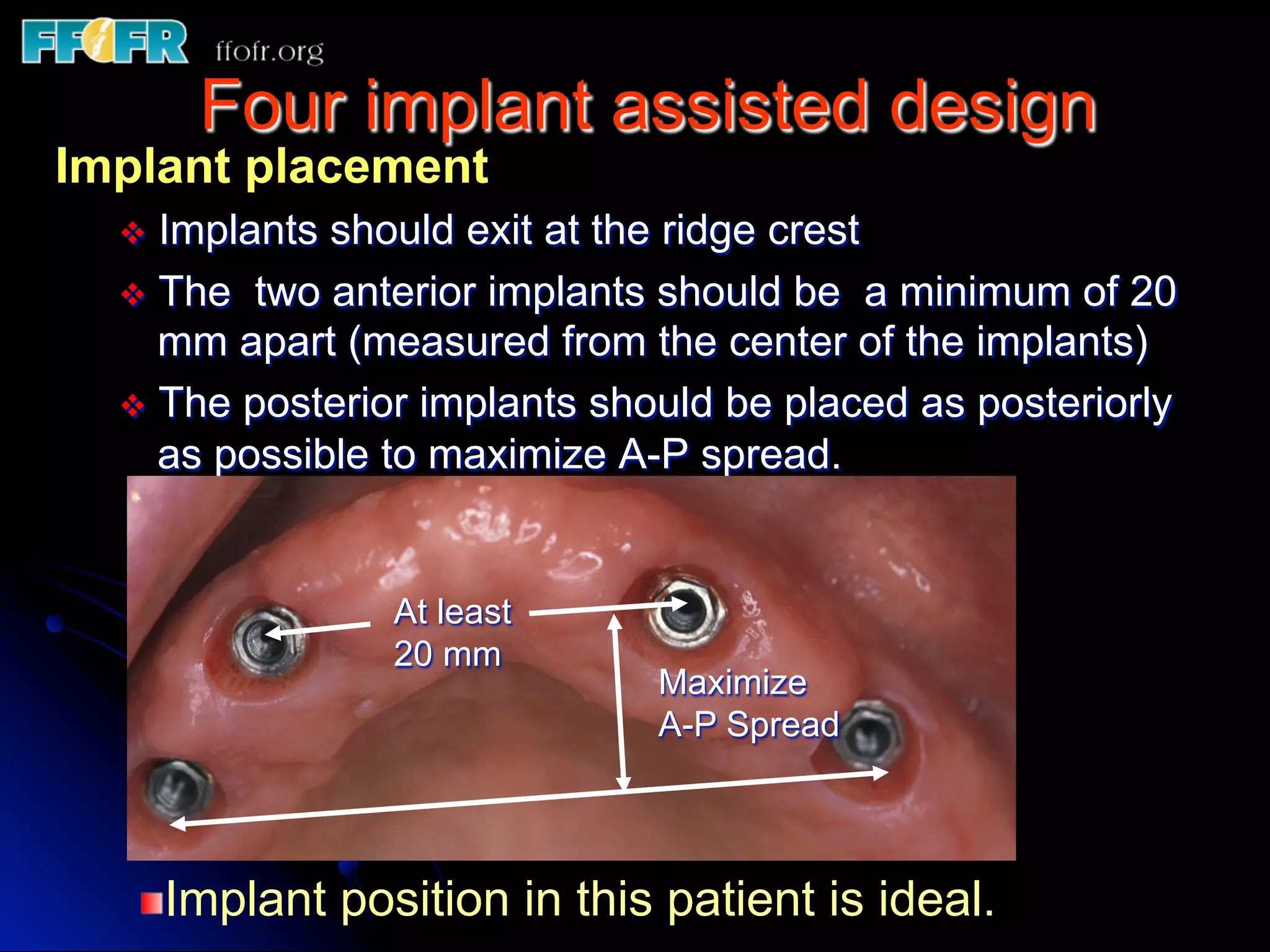 Edentulous Maxilla - Overlay Dentures | PDF