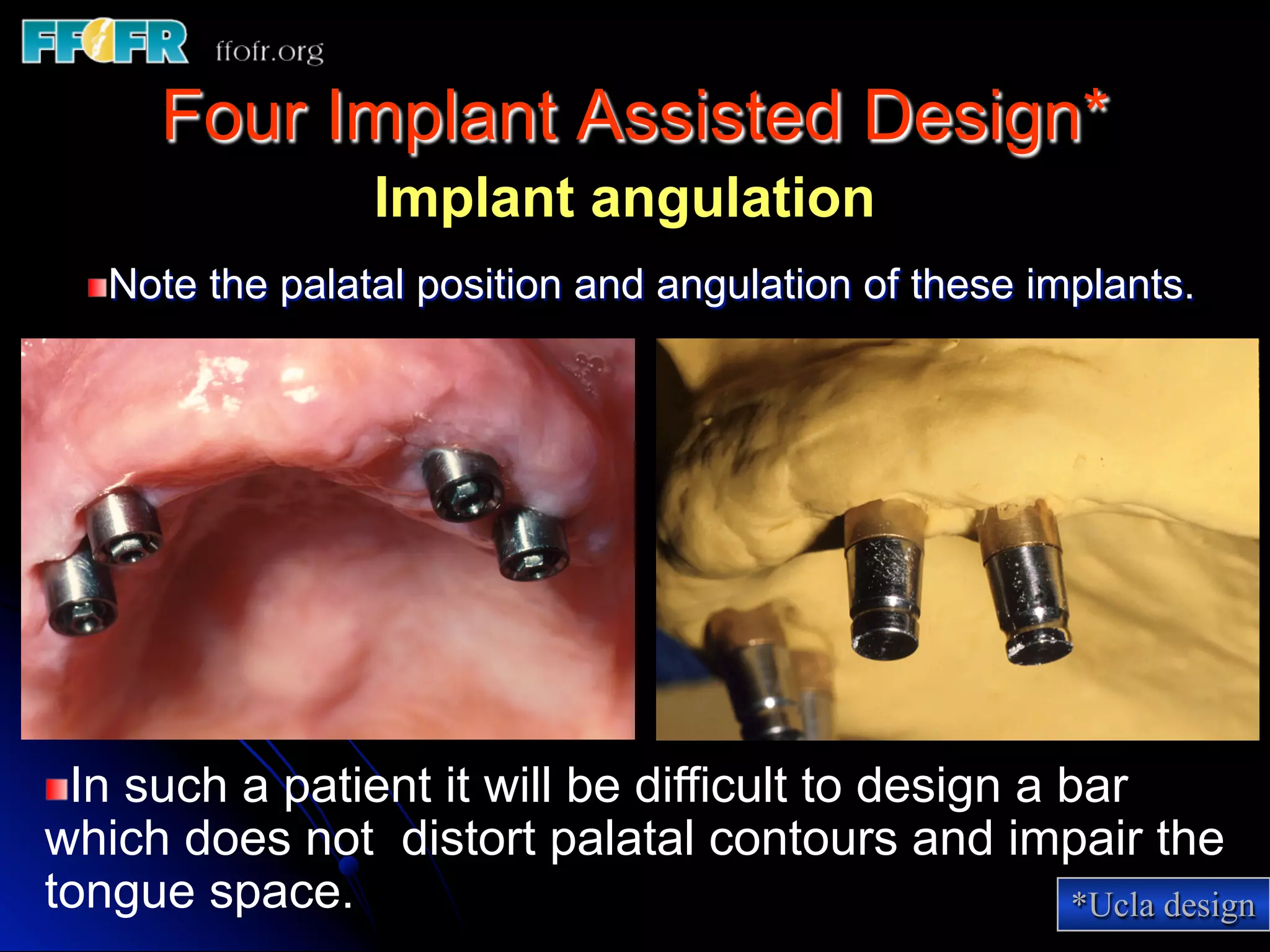 Edentulous Maxilla - Overlay Dentures | PDF