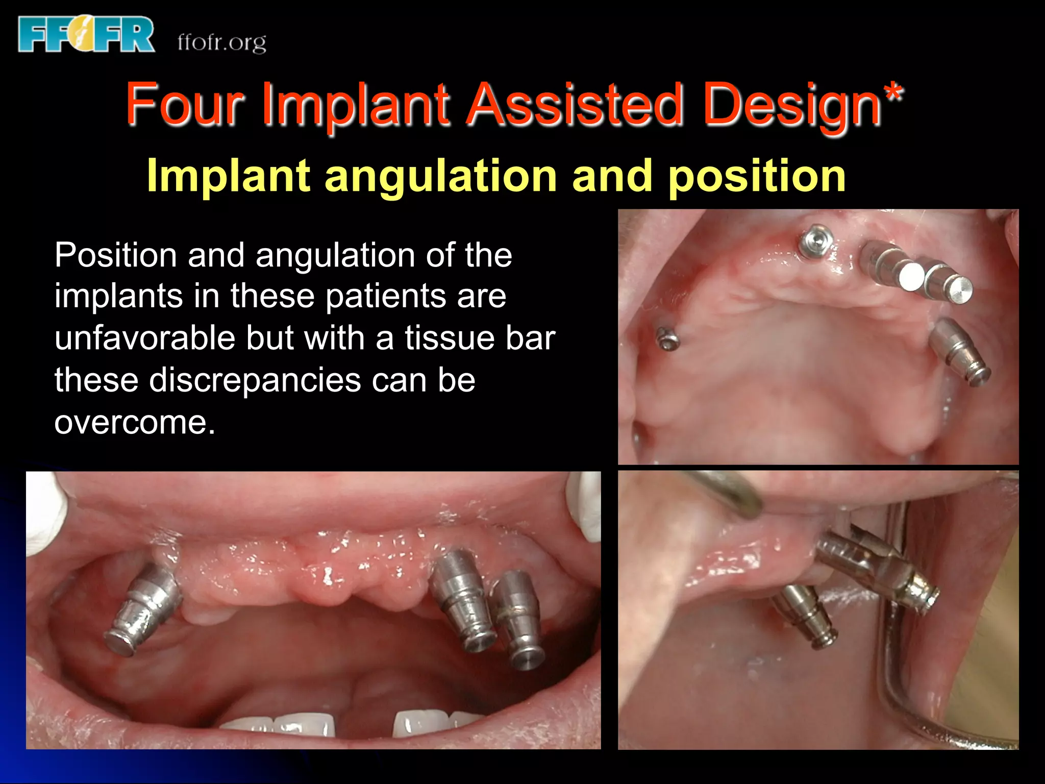 Edentulous Maxilla - Overlay Dentures | PDF