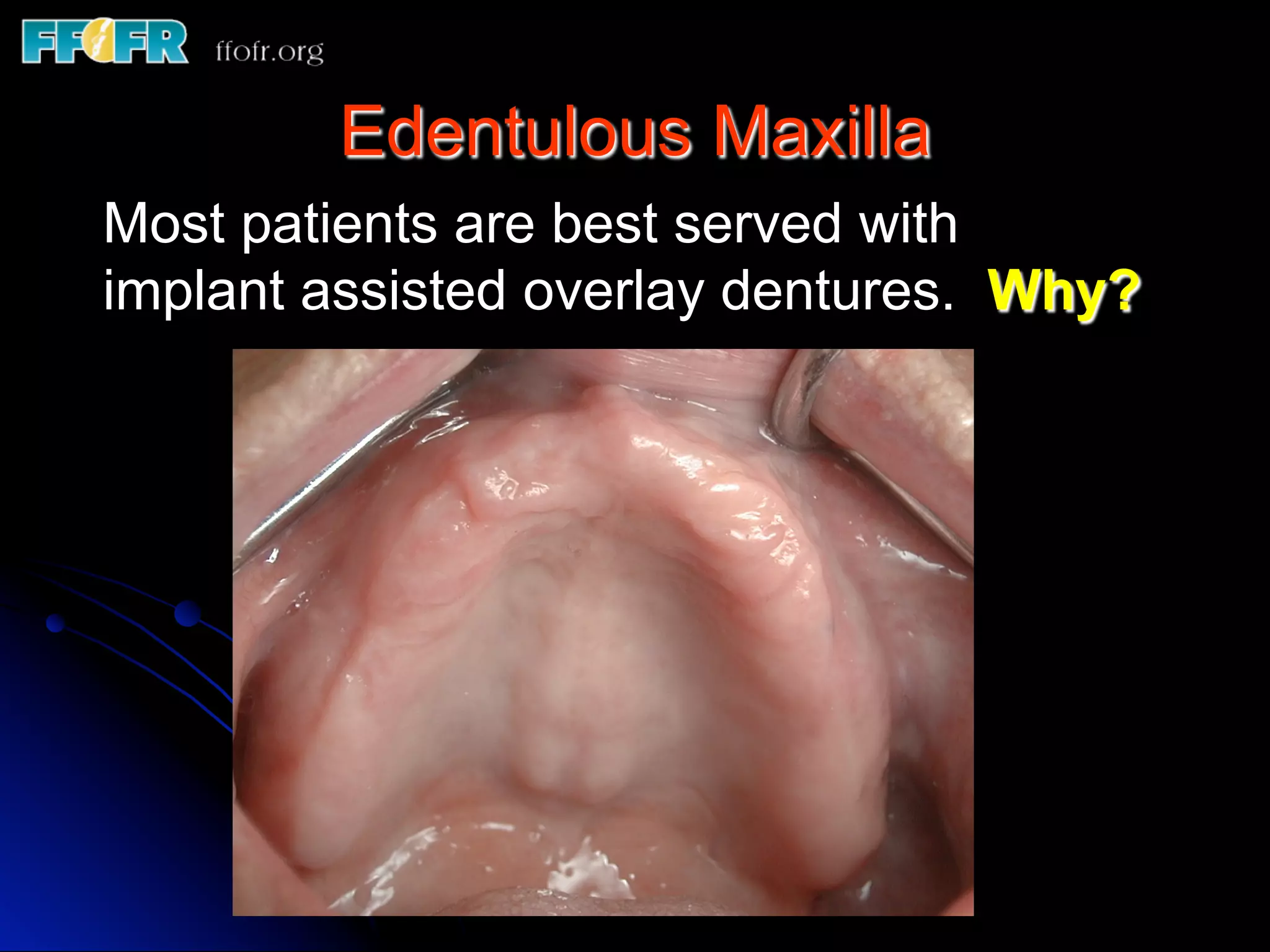 Edentulous Maxilla - Overlay Dentures | PDF
