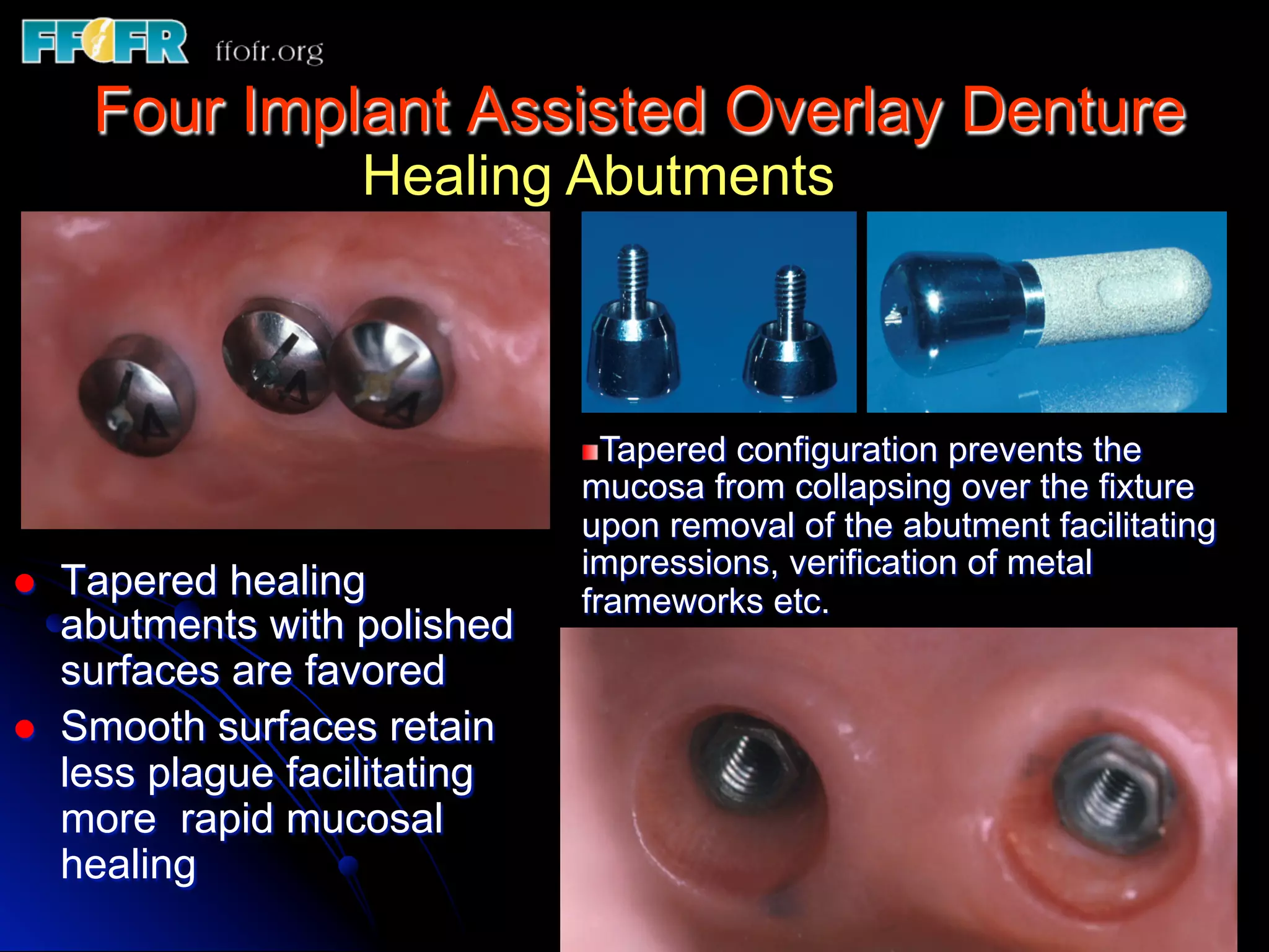 Edentulous Maxilla - Overlay Dentures | PDF