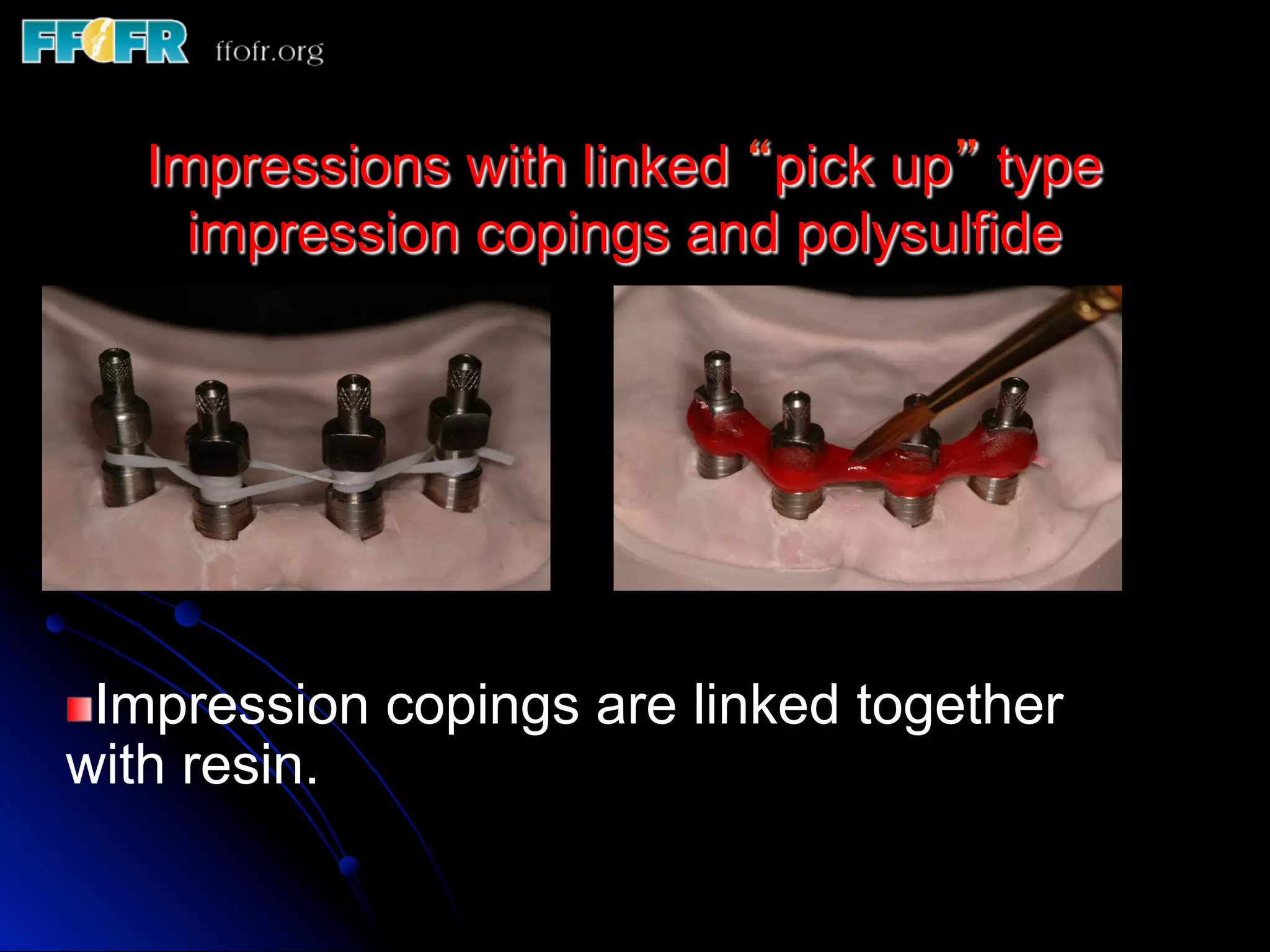 Edentulous Maxilla - Overlay Dentures | PDF