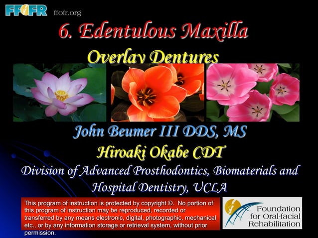 Edentulous Maxilla - Overlay Dentures | PDF