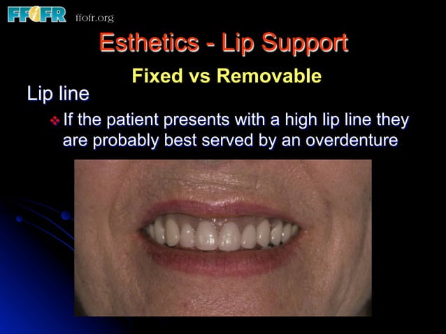 Edentulous Maxilla - Overlay Dentures | PDF