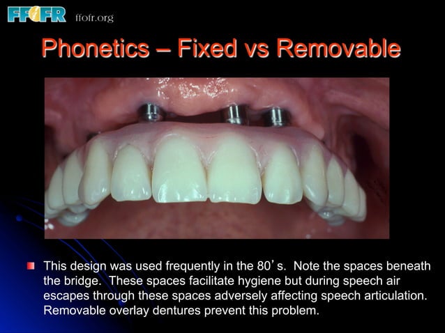Edentulous Maxilla - Overlay Dentures | PDF