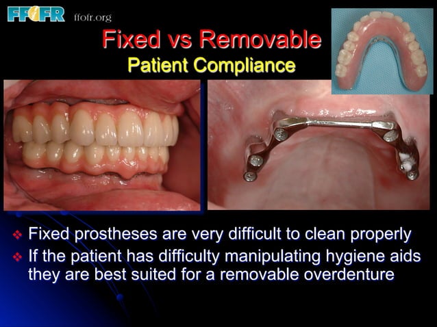 Edentulous Maxilla - Overlay Dentures | PDF