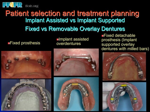 Edentulous Maxilla - Overlay Dentures | PDF