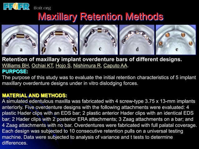 Edentulous Maxilla - Overlay Dentures | PDF