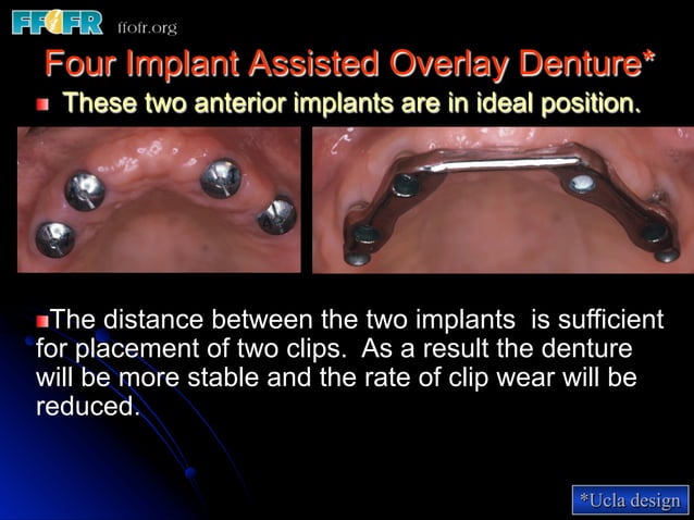 Edentulous Maxilla - Overlay Dentures | PDF