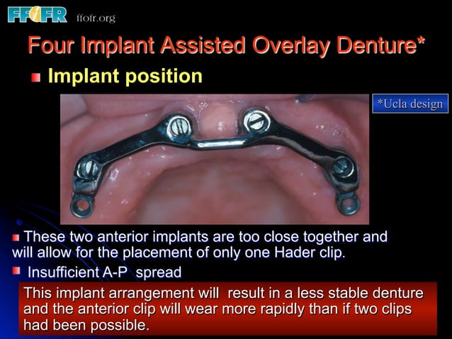 Edentulous Maxilla - Overlay Dentures | PDF