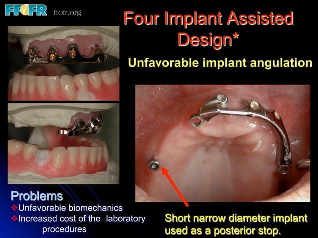 Edentulous Maxilla - Overlay Dentures | PDF