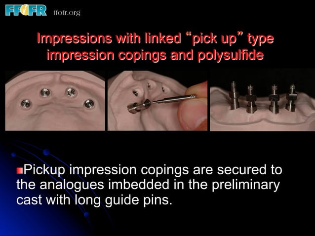 Edentulous Maxilla - Overlay Dentures | PDF