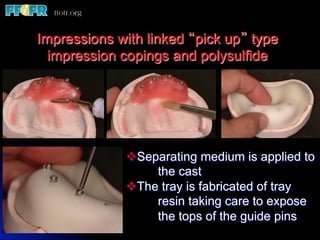 Edentulous Maxilla - Overlay Dentures | PDF