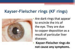 6. fernandez wilson's disease | PPT