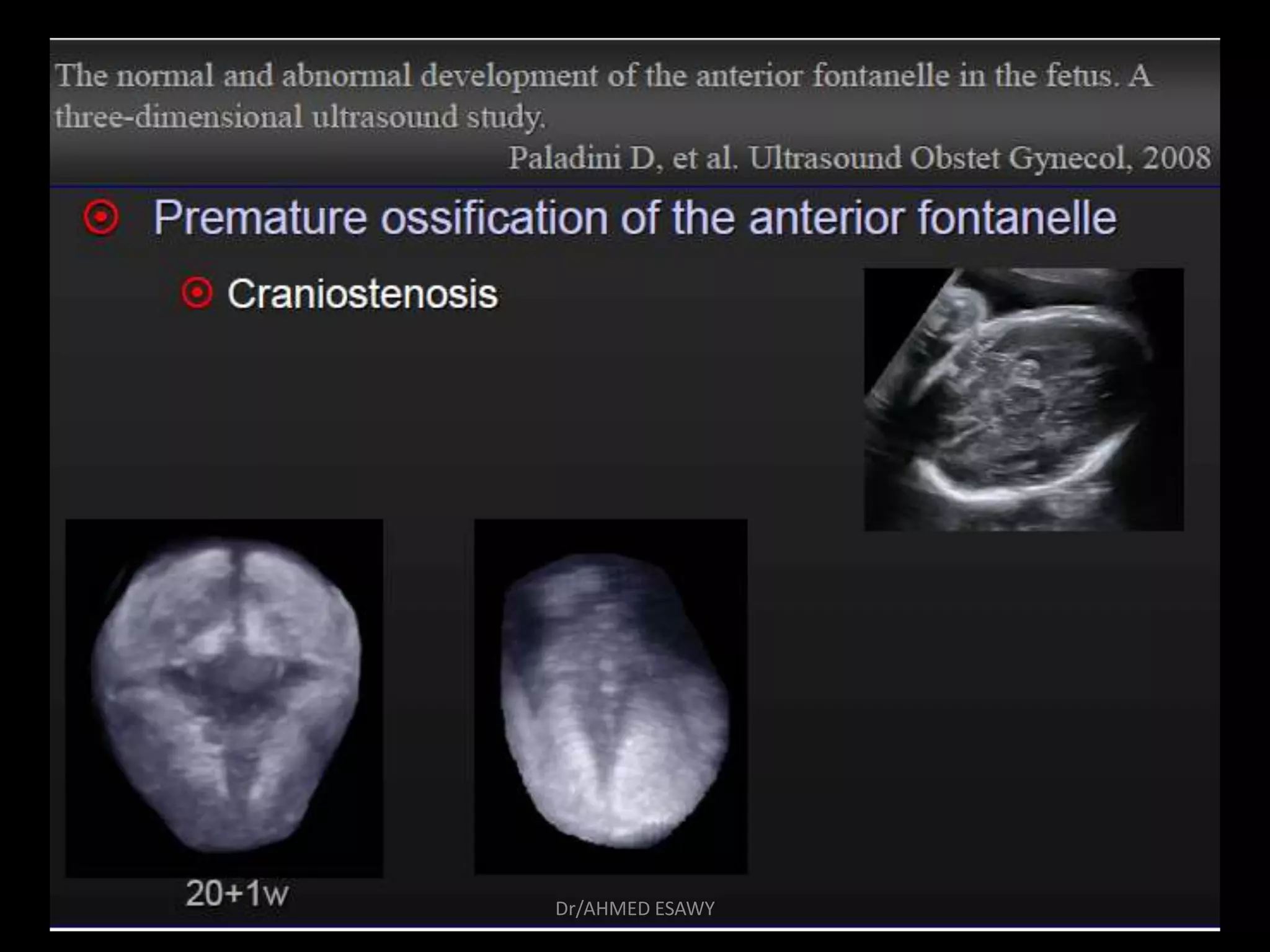 6 Fetal Skull Dr Ahmed Esawy Ppt