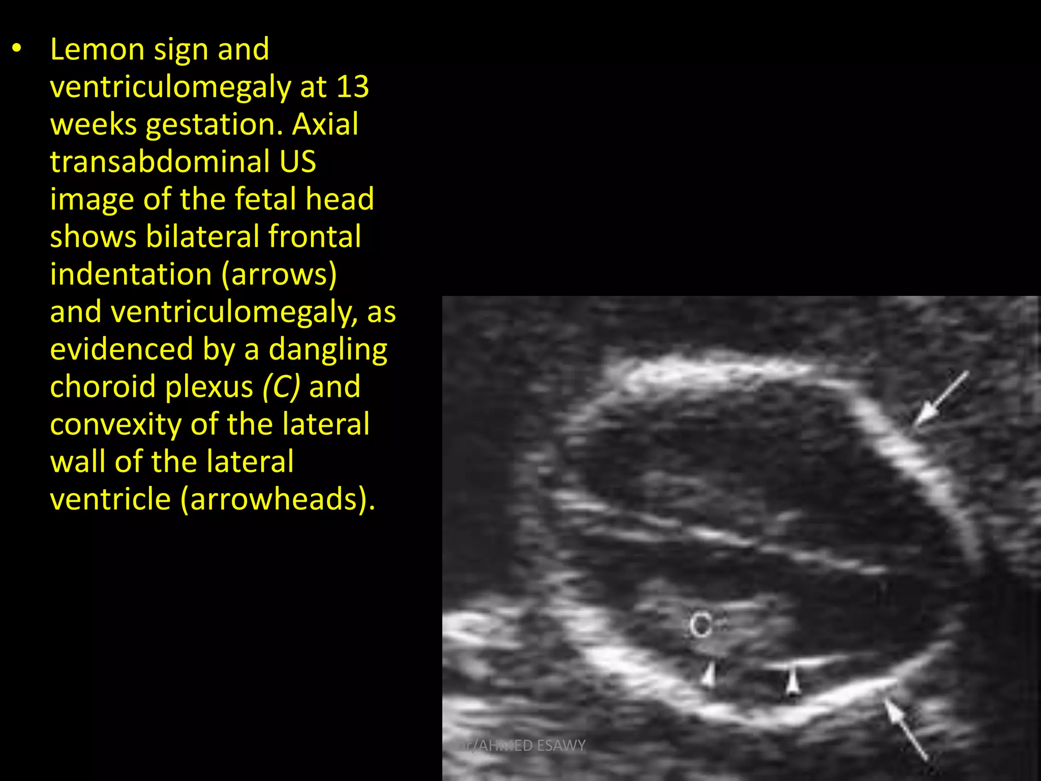 6 Fetal skull Dr Ahmed Esawy | PDF