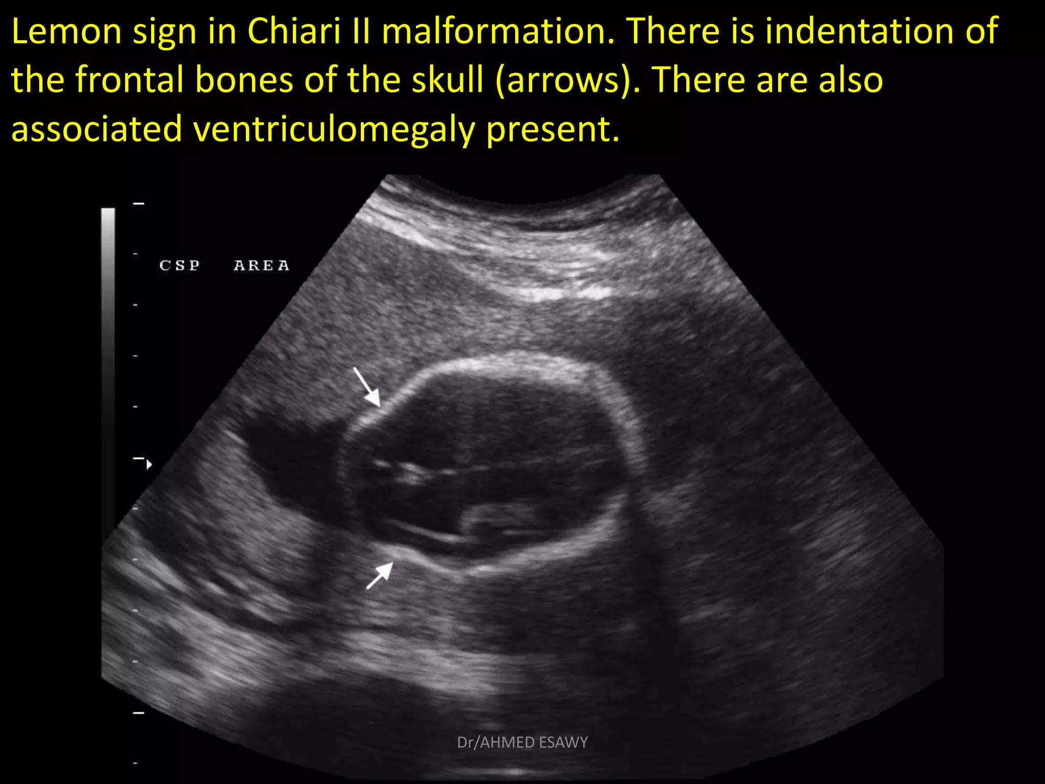 6 Fetal skull Dr Ahmed Esawy | PDF