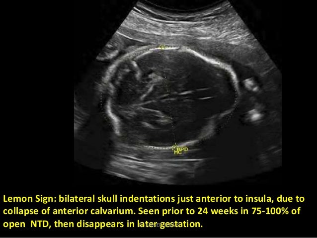 6 Fetal skull Dr Ahmed Esawy