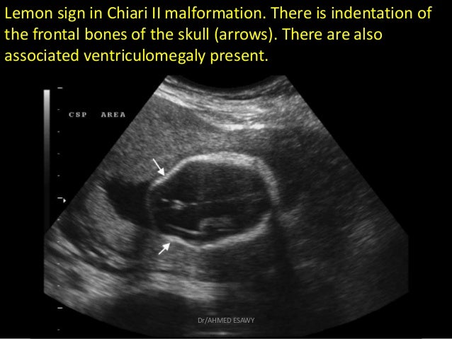 6 Fetal skull Dr Ahmed Esawy