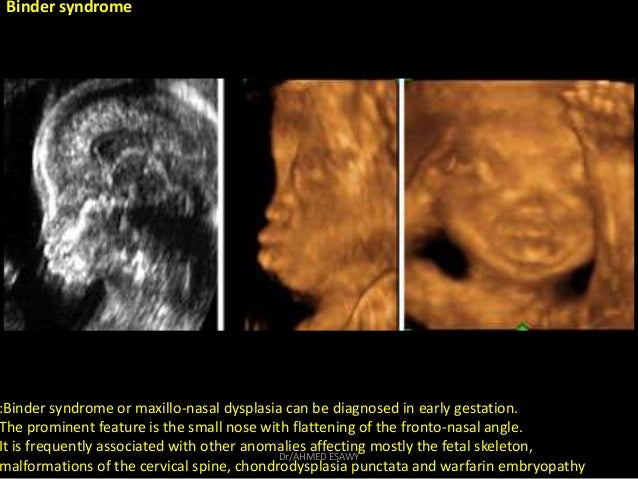 6 Fetal skull Dr Ahmed Esawy