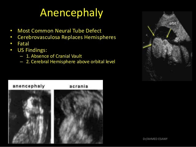6 Fetal skull Dr Ahmed Esawy