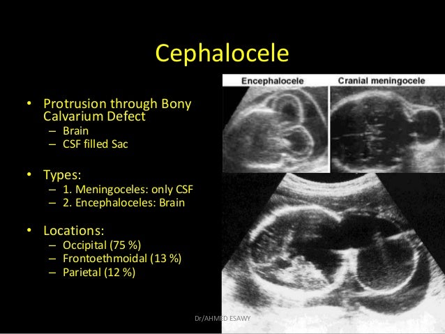 6 Fetal skull Dr Ahmed Esawy