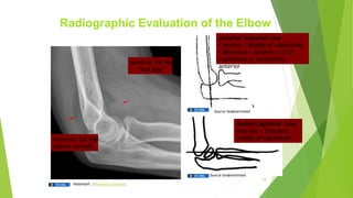 Fracture of upper limb and physical thet | PPTX