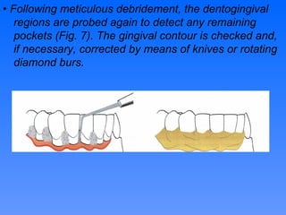 gingivectomy | PPT
