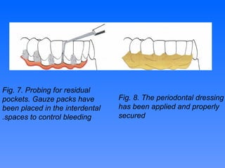 gingivectomy | PPT