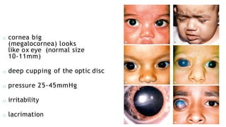 6-Glaucoma and Anterior Segment Diseases.pptx