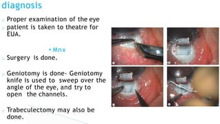 6-Glaucoma and Anterior Segment Diseases.pptx