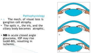 6-Glaucoma and Anterior Segment Diseases.pptx