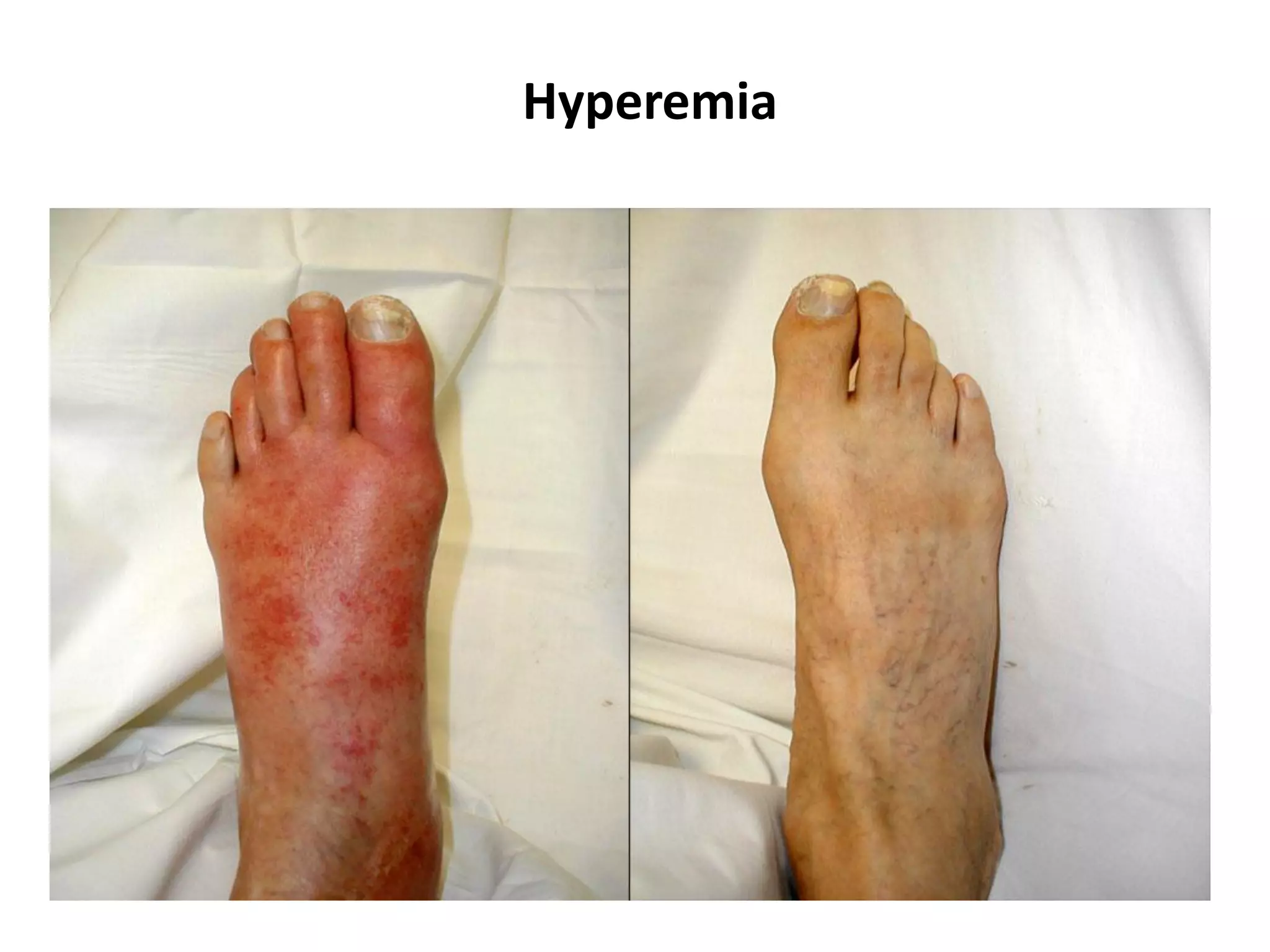 6 hemodynamic disorders | PDF