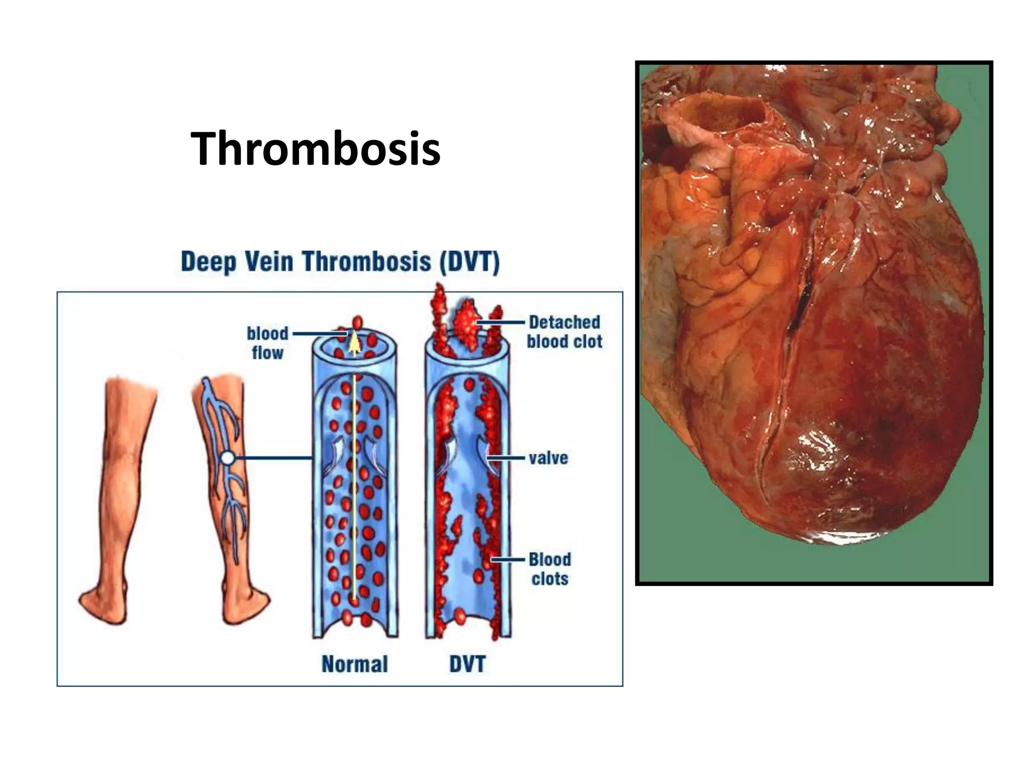 6 hemodynamic disorders | PDF