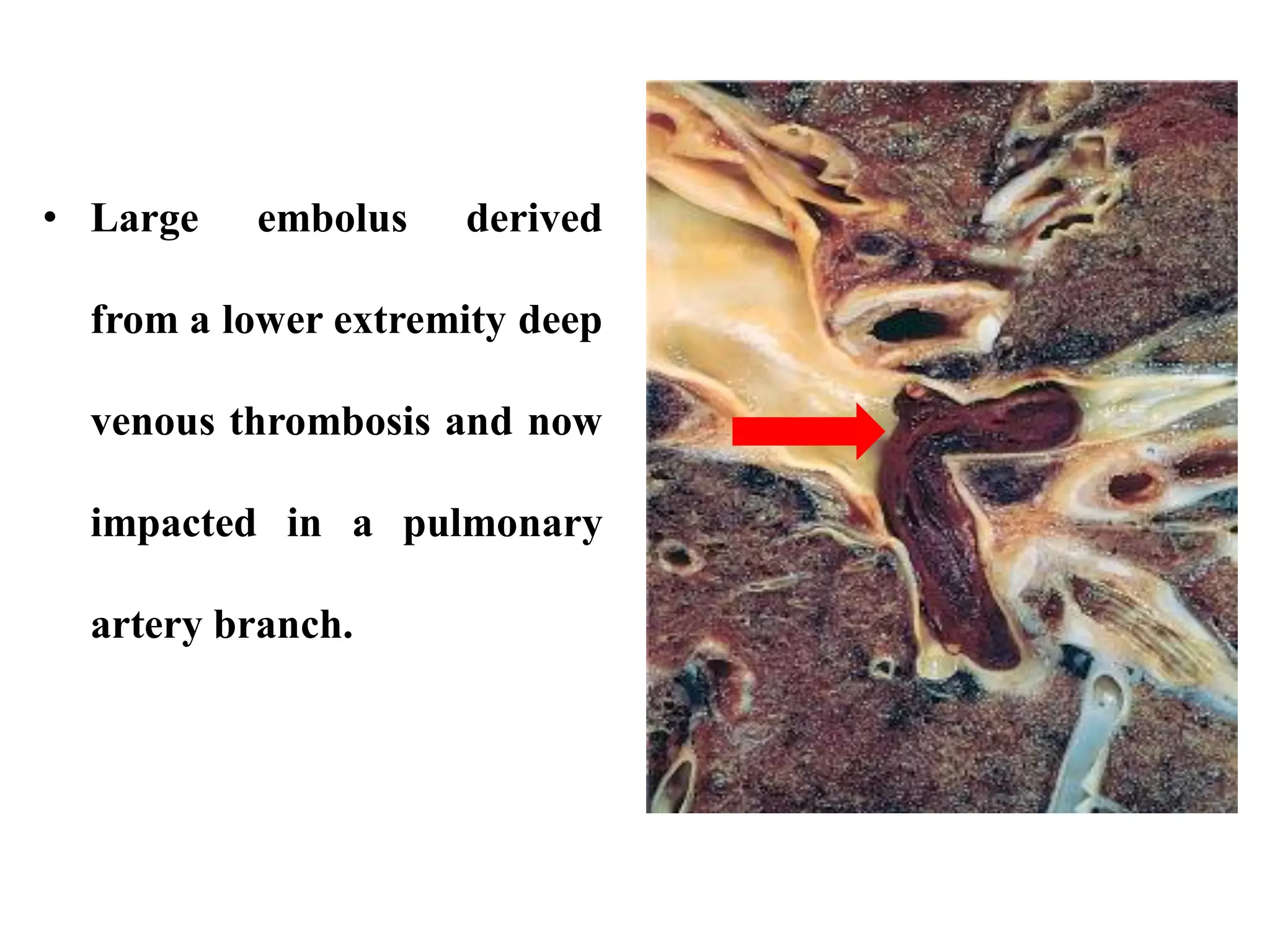 6 hemodynamic disorders | PDF