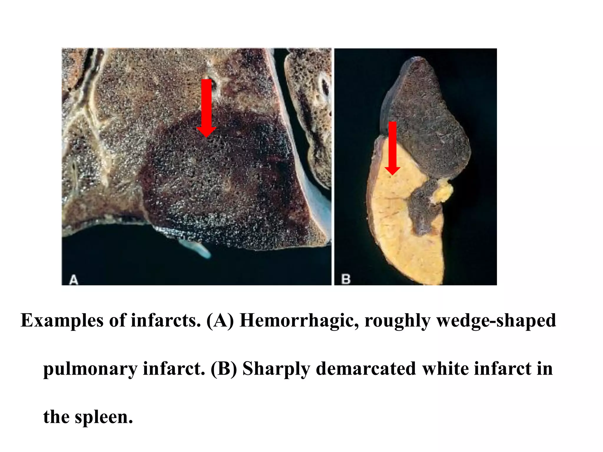 6 hemodynamic disorders | PDF