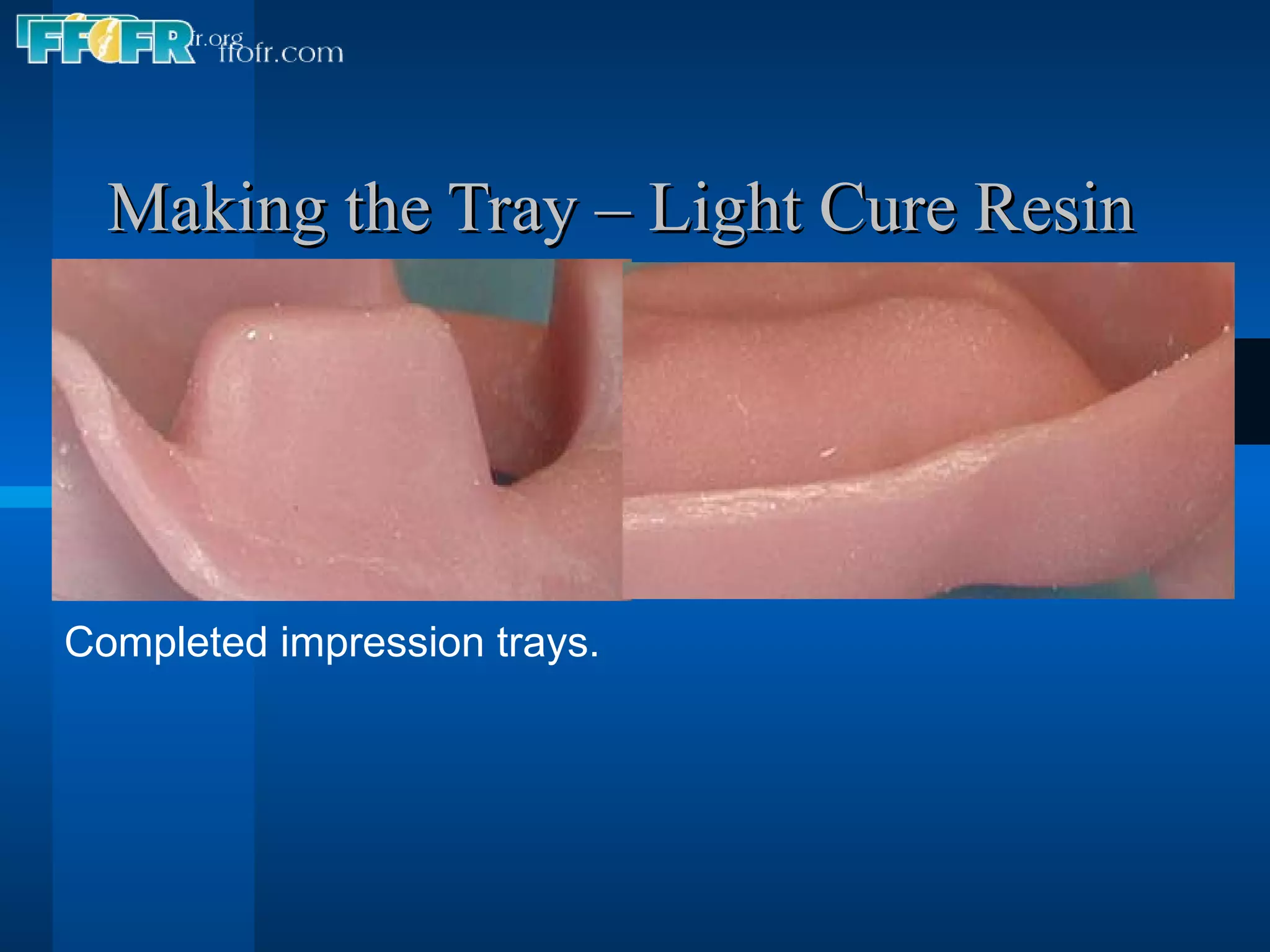 6. impression tray fabrication | PPT