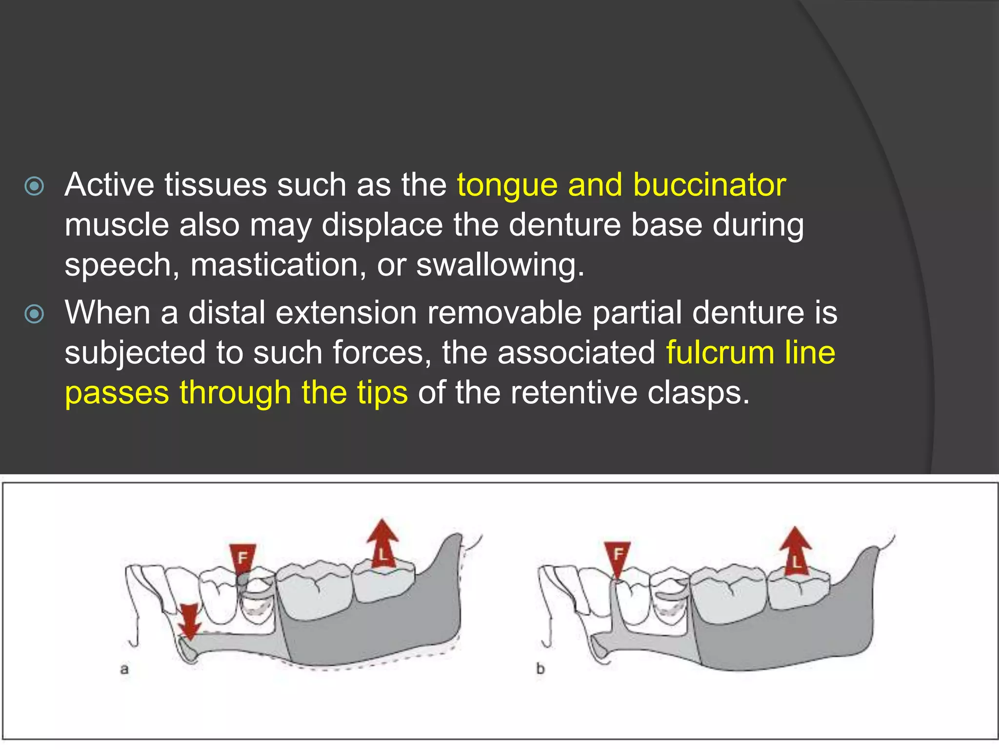 INDIRECT RETAINERS IN REMOVABLE PARTIAL DENTURES | PPTX