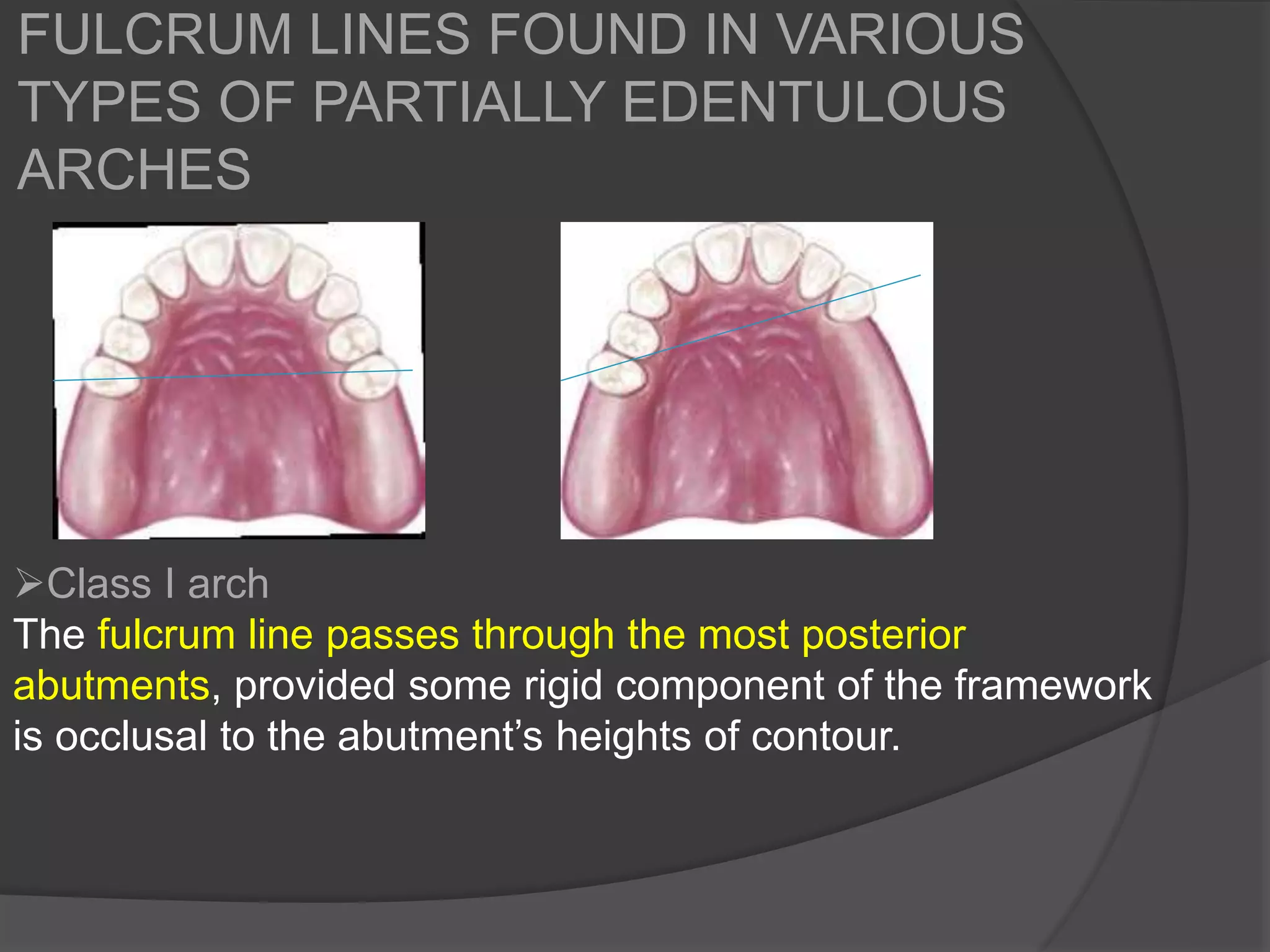 INDIRECT RETAINERS IN REMOVABLE PARTIAL DENTURES | PPTX