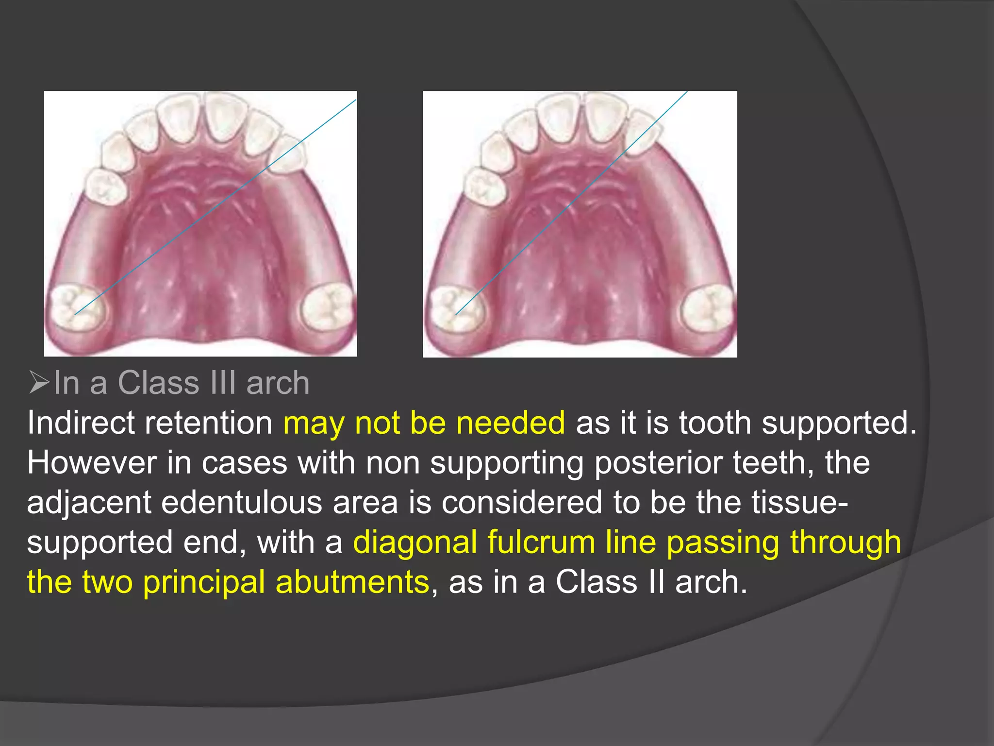 INDIRECT RETAINERS IN REMOVABLE PARTIAL DENTURES | PPTX
