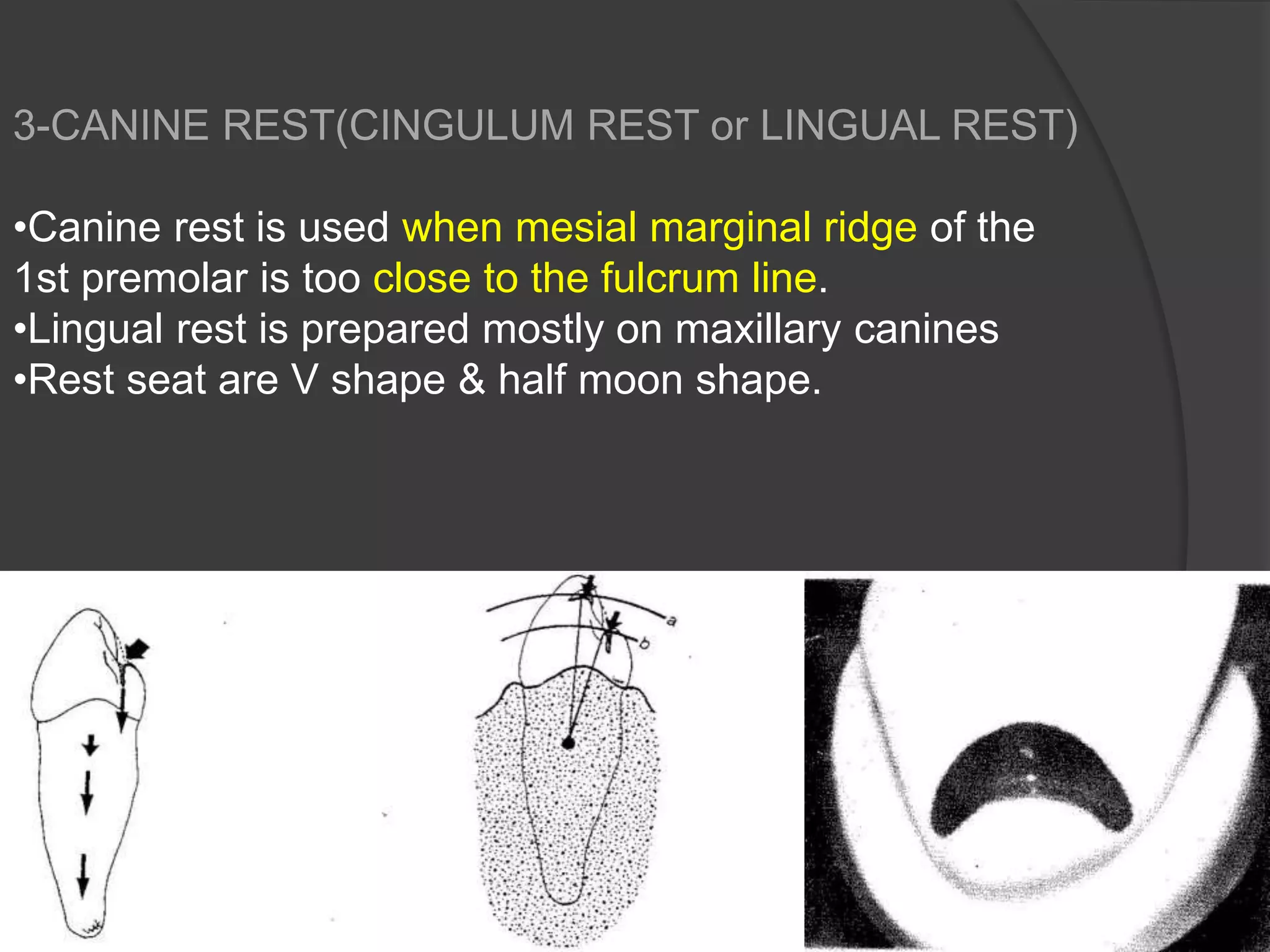 INDIRECT RETAINERS IN REMOVABLE PARTIAL DENTURES | PPTX
