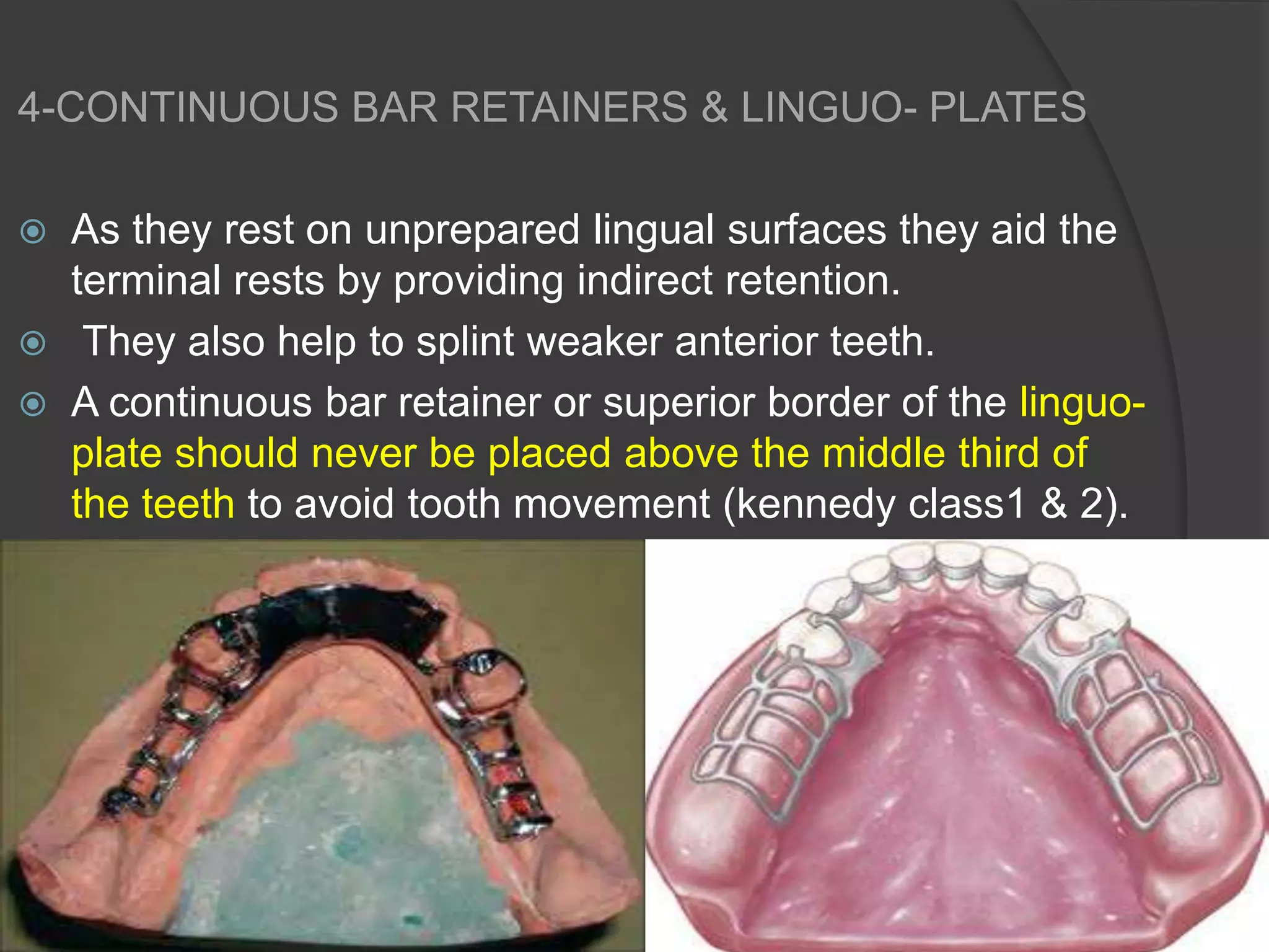 INDIRECT RETAINERS IN REMOVABLE PARTIAL DENTURES | PPTX