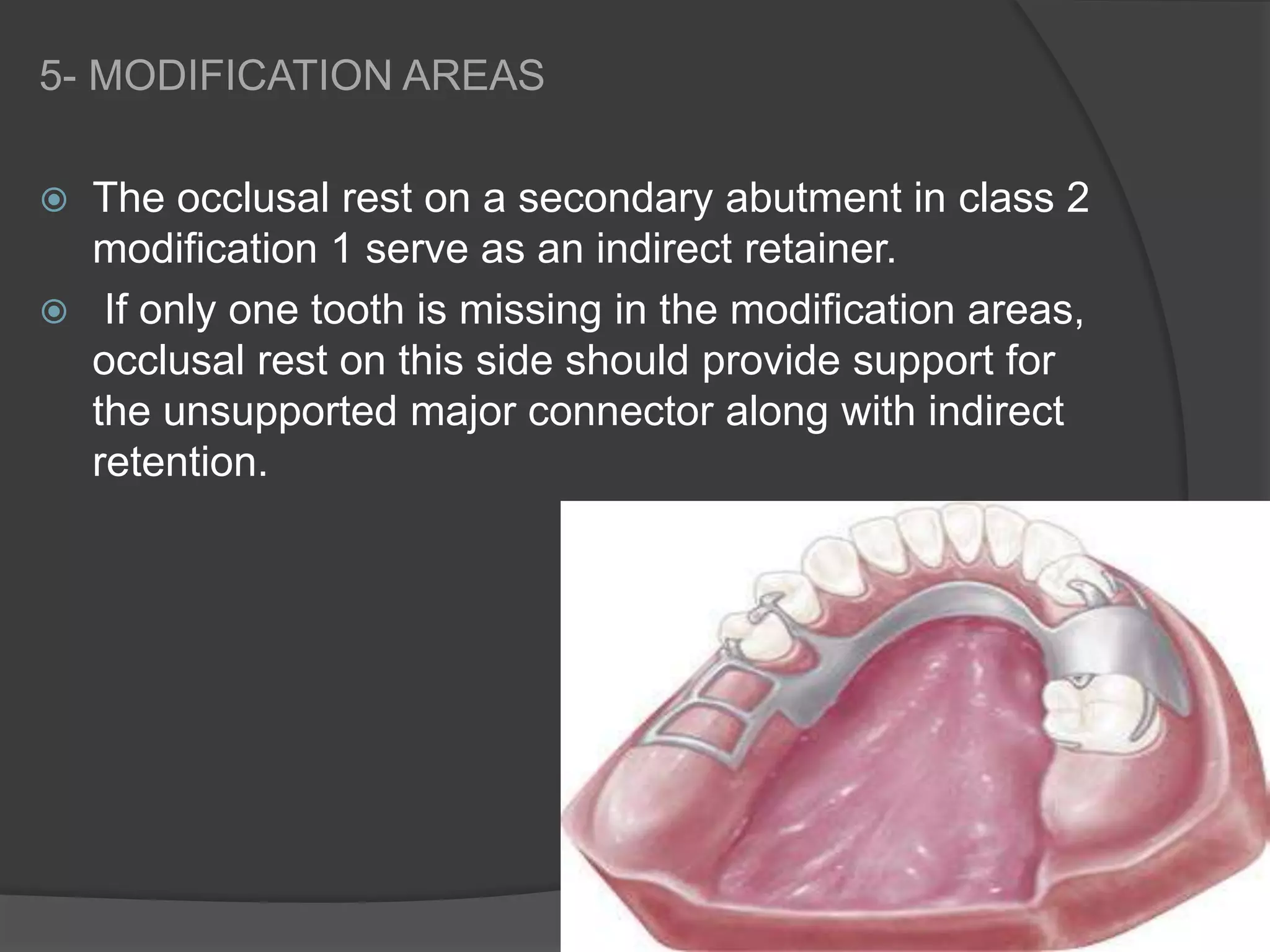 INDIRECT RETAINERS IN REMOVABLE PARTIAL DENTURES | PPTX