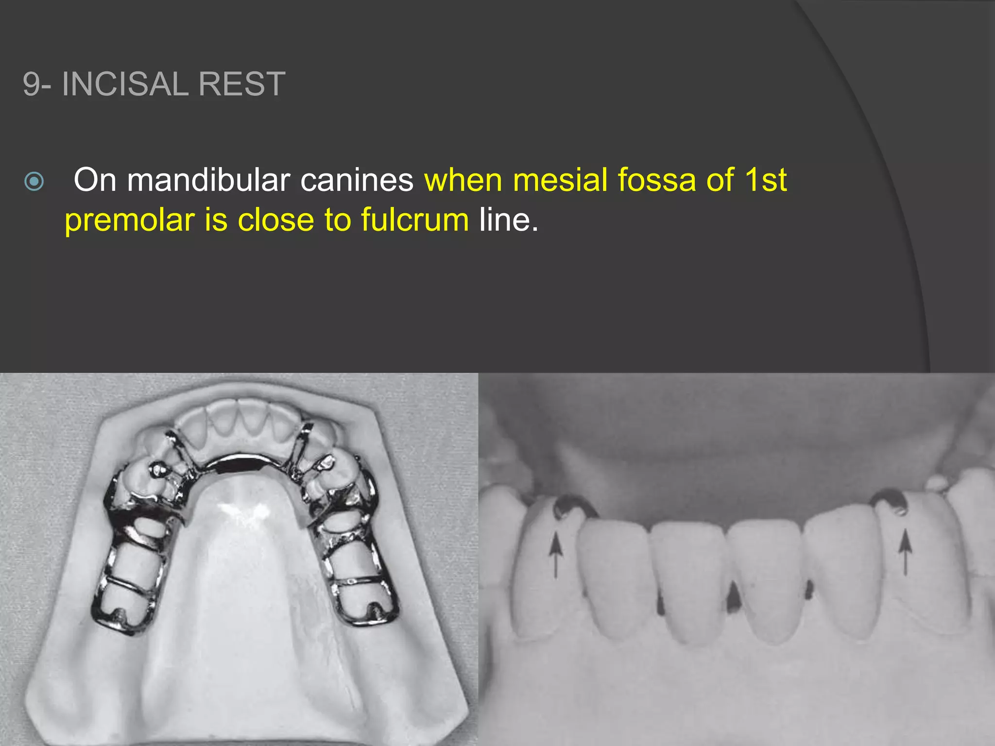 INDIRECT RETAINERS IN REMOVABLE PARTIAL DENTURES | PPTX