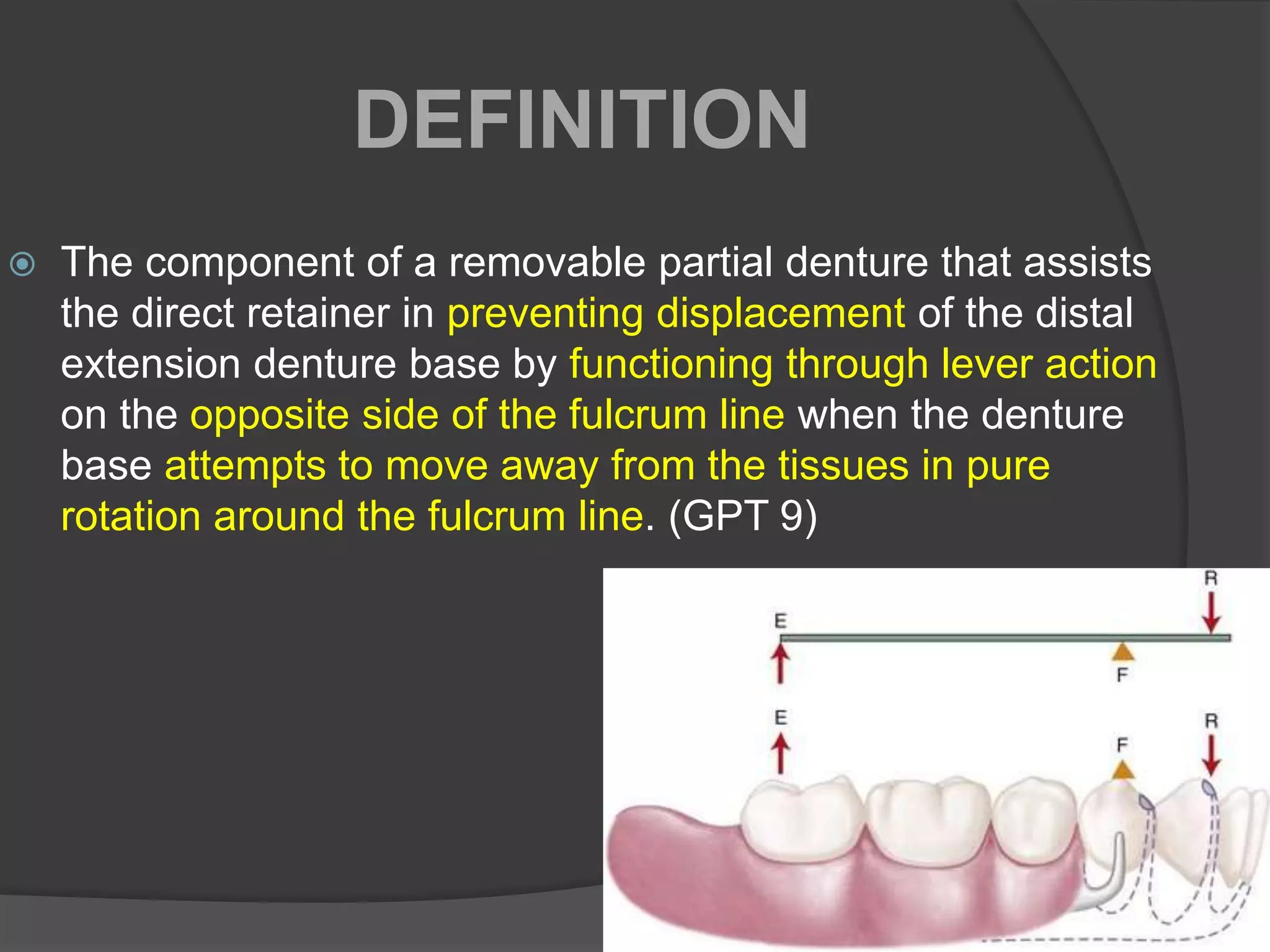 INDIRECT RETAINERS IN REMOVABLE PARTIAL DENTURES | PPTX